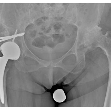 Dysplastic Hip Patient With Bilateral Sub Dislocation Classified As