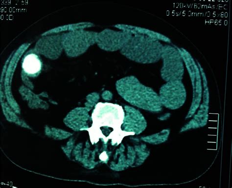 Gallstone Ileus A Rare Type Of Intestinal Obstruction In Ghana Pmc