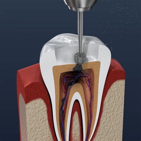 P334 Root Canal Anatomy And Endodontic Access Cavity Prodental Cpd