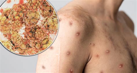 Who Issues Bleak Monkeypox Warning Hundreds Of Cases Found