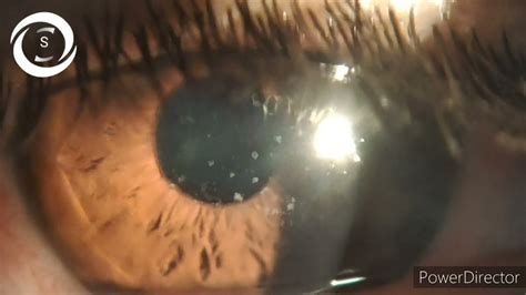 Adenoviral Keratitis
