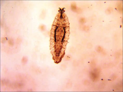 Unilateral Conjunctivitis Of Unique Etiology A Case Report From Eastern India Pmc