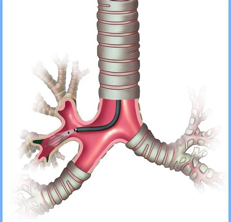 Experience With Bronchoscopy Pulmonary Hypertension News Forums