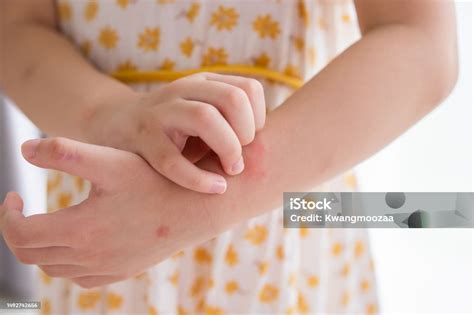 어린 소녀는 피부 발진 알레르기 가려움증과 팔에 긁히는 것을 가지고 있습니다 아이에 대한 스톡 사진 및 기타 이미지 아이 알레르기 발진 Istock