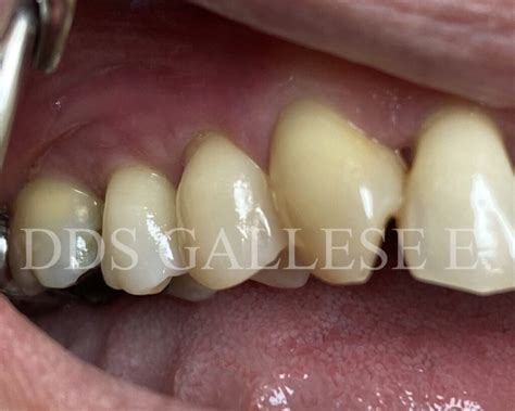 Comment Traiter Une Gencive Rétractée Et Préserver Votre Sourire