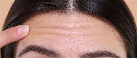Forehead Lines Causes And Botox Treatment Advice Nursethetics Forehead Lines Causes And Botox Treatment Advice Nursethetics