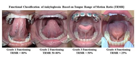Labial Frenectomy Before And After