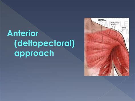 The Deltopectoral Approach Pdf