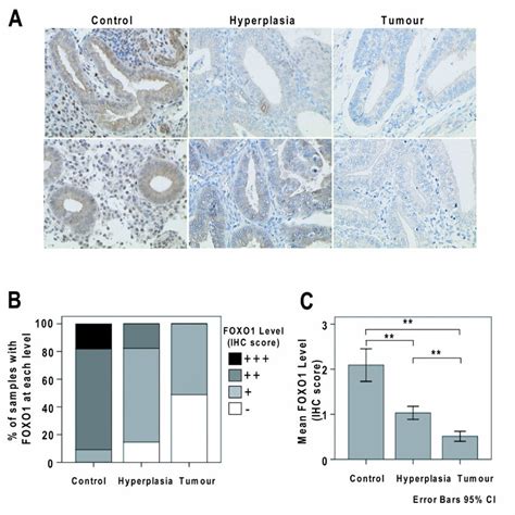 Downregulation Of Foxo1 Staining In Hyperplasia And Type I Endometrial Download Scientific