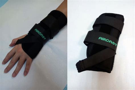 The Single Visit Treatment Of Pediatric Distal Radius Buckle Fractures