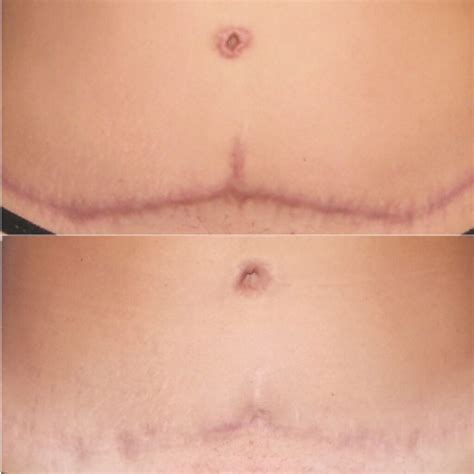 Reclaim Your Skin The Ultimate Guide To Scar Camouflage Tattoos