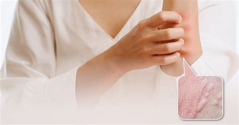 Chronic Urticaria Diagnosis Package Bangkok Hospital Headquarter