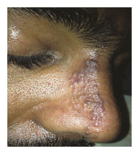 Multiple Hyperpigmented Papules And Some Vesicles Present Over The Download Scientific Diagram