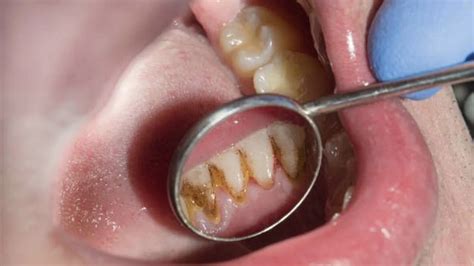 ¿por Qué Se Te Pueden Caer Los Dientes Como A Luisito Comunica Éstas