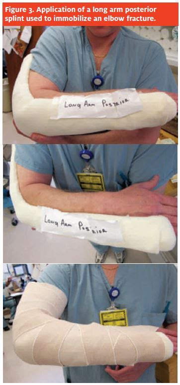 Posterior Splint Elbow Fracture