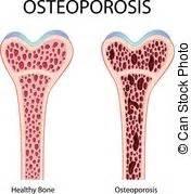 Osteoporosis Clipart 17 Free Cliparts Download Images On Clipground 2026