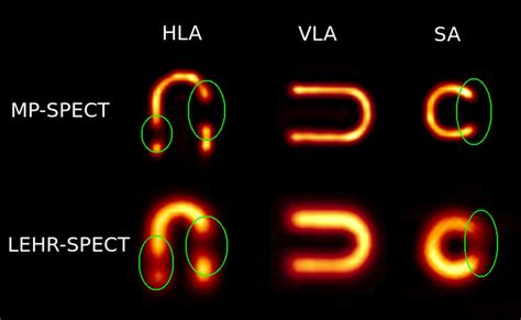 Performance Evaluation Of Stationary Dedicated Cardiac Spect With Multi