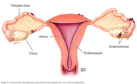 Endometriosis Pictures A Visual Guide To Understanding The Condition