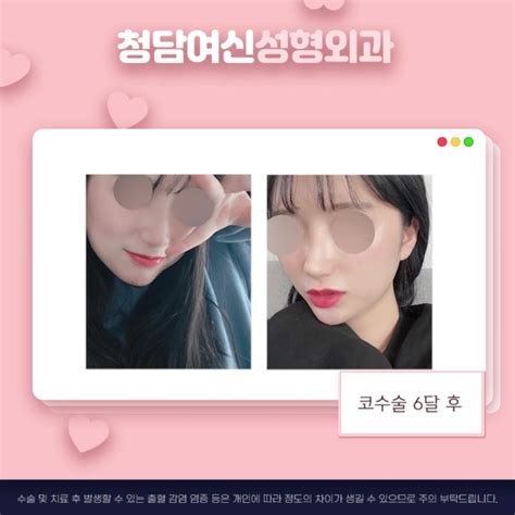 💜청담여신💜 청담여신코수술후기💜 코 때문에 남성적인 느낌이 나서 스트레스였는데 청담여신에서 여신코라인으로 개선💜 청담여신덕분에
