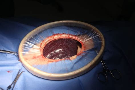 Alexis Wound Protector Retractor Single Unit