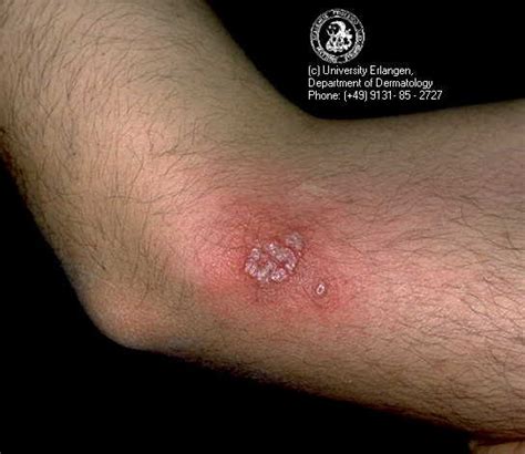 Buribalek Herpes Simplex 2