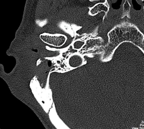 Sinusitismastoiditis Undergradimaging Nc Commons