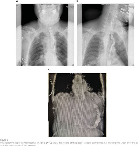 Figure 2 From Thoracoscopic Esophagectomy For Thoracic Esophageal Cancer With Right Aortic Arch