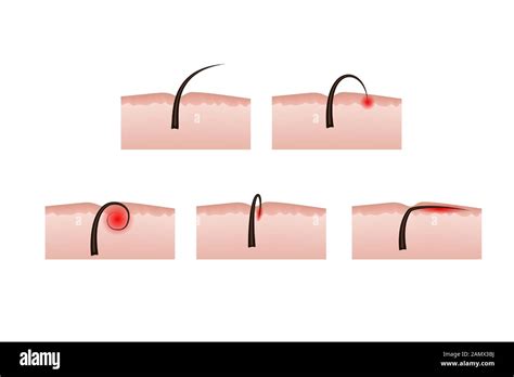 Ingrown Hairs After Depilation Vector Illustration Skin Structure Stock Vector Image And Art Alamy