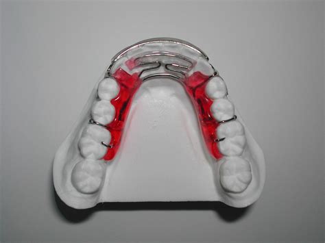 Spring Retainer Teeth At Marisa Randolph Blog