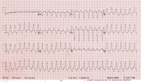 Ecg Educator Blog Supraventricular Tachycardia Svt