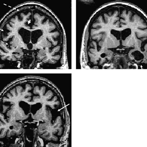 Mri Findings In Cjd A B A Patient With Probable Variant Cjd And Download Scientific Diagram