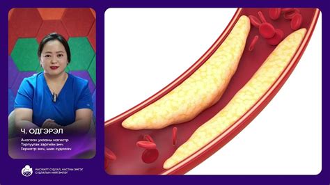 Атеросклероз өвчин гэж юу вэ Youtube