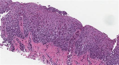 Eosinophilic Esophagitis Atlas Of Pathology