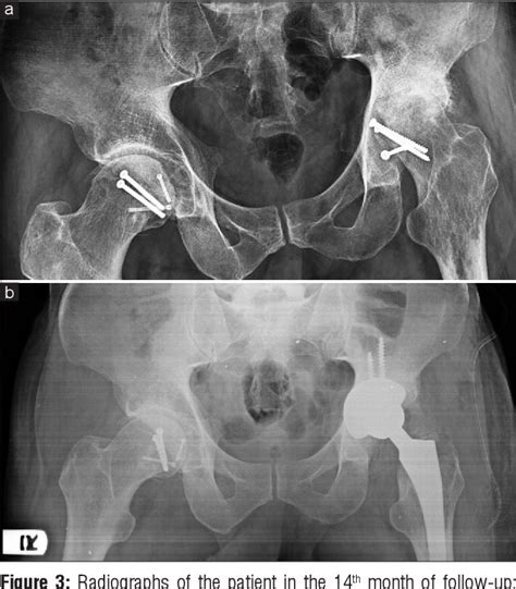 Figure 3 From Complex Bilateral Posterior Hip Dislocation With A Long Term Follow Up—a Case