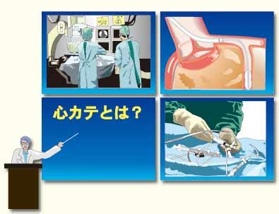 カテーテル法 meddic