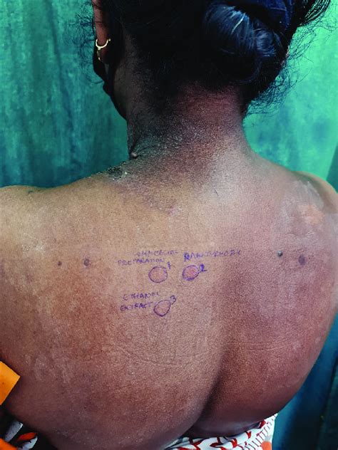 Positive Patch Test Reaction To Raw Turmeric And Ethanol Extract Of