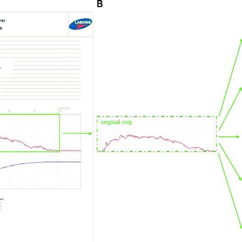An Outline Of Uroflowmetry Graph Extraction And Data Augmentation Download Scientific Diagram