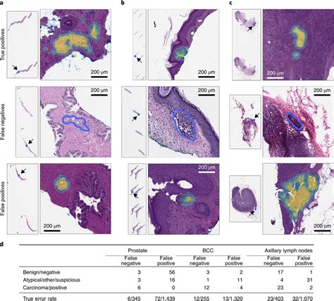 Clinical Grade Computational Pathology Using Weakly Supervised Deep