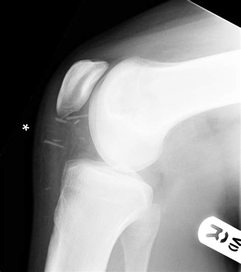 Test Yourself Regular Sets Set 29 Emergency Department Foreign Bodies Radiology Courses