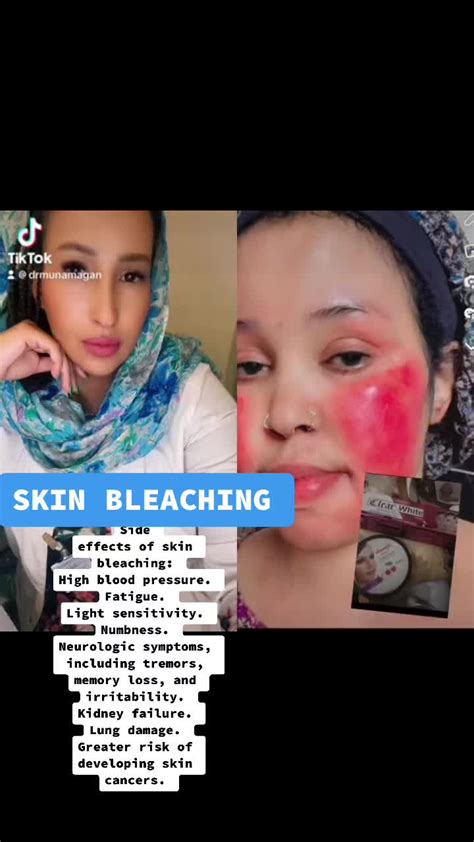Skin Bleaching Side Effects