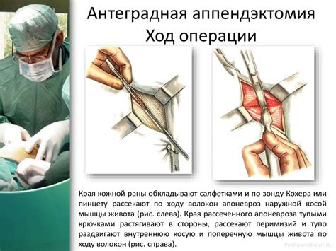 Аппендектомия Способы аппендэктомии презентация онлайн