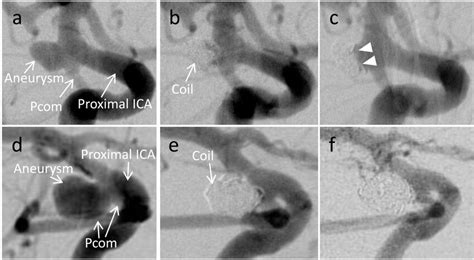 Representative Cases A Pretreatment Right Internal Carotid Artery Download Scientific