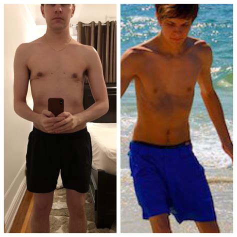 Fotos Fotos Pectus Excavatum Chest Wall Dr Min Kim Thoracic