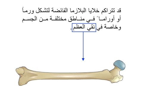 الورم النقوي المتعدد