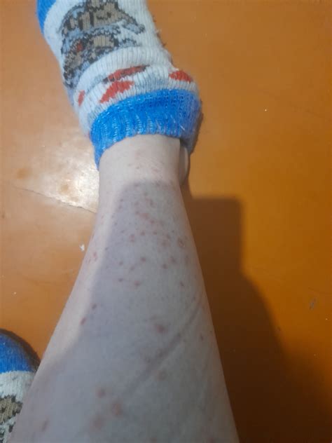 Сыпь на ноге Появилась сыпь Сначала лечили аллергию потом чечотку Результата Medaboutme