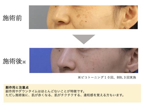 ピコトーニング 肝斑かんぱんくすみ毛穴たるみ治療におすすめ 笹塚駅前こたろ形成皮ふ科クリニック 京王線笹塚駅すぐ