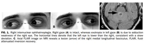 Ocular Motor Manifestations Of Multiple Sclerosis Livewisems