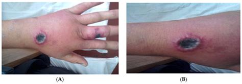 Human Anthrax Update Of The Diagnosis And Treatment