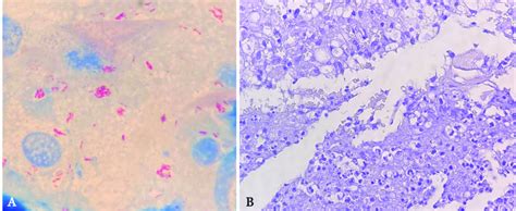 Acid Fast Bacilli Afb Test And Histopathology Of The Patient A