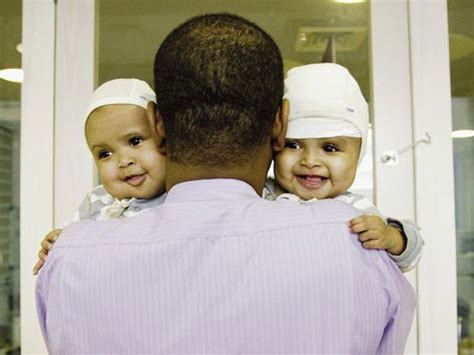 Craniopagus Twins Separated By Ben Carson